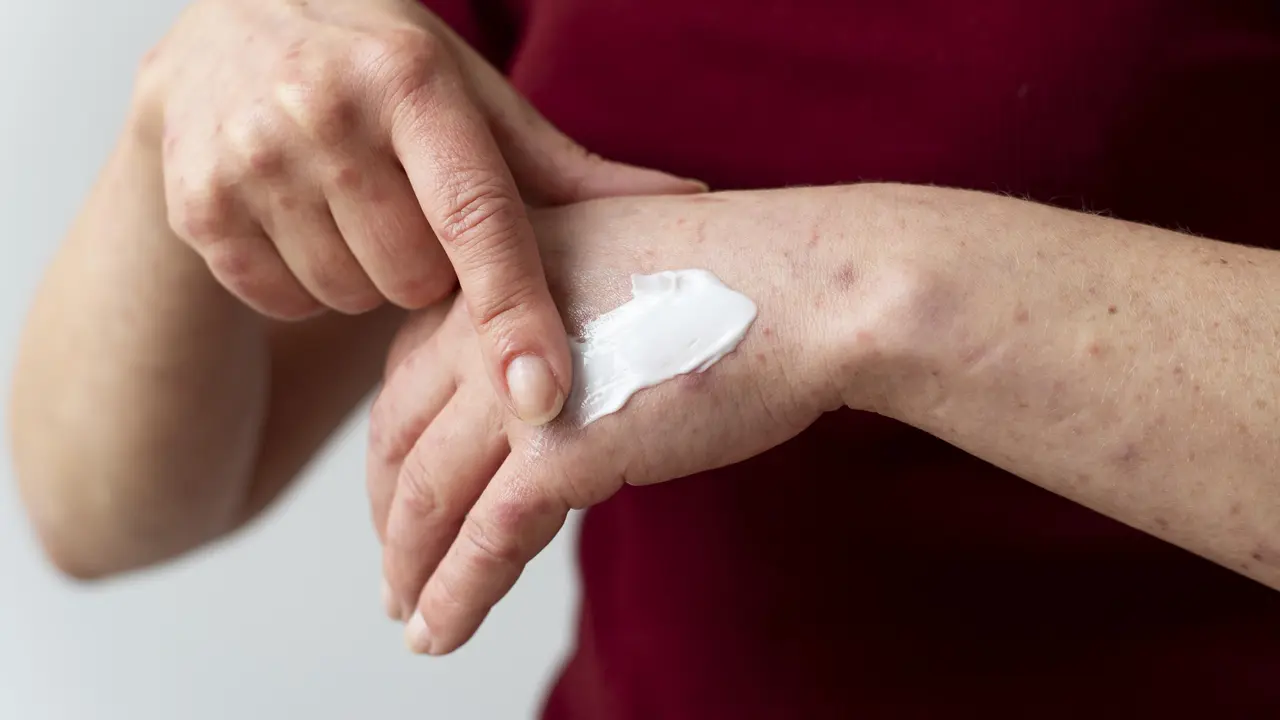 7 Gejala Alergi Obat yang Harus Diketahui, Tanda-Tanda Kecil Bisa ...