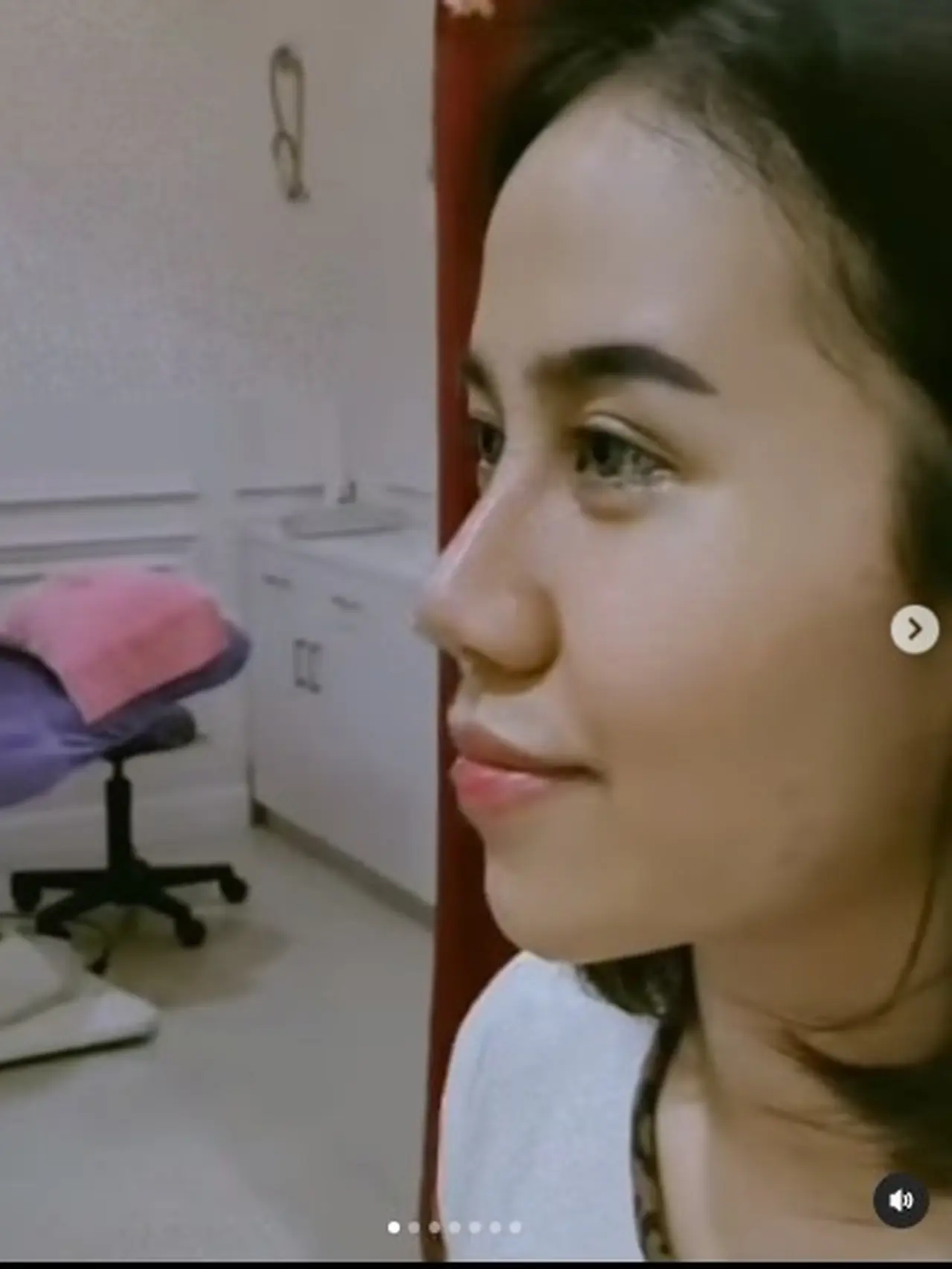 8 Potret Perubahan Wajah Mayang Usai Operasi Hidung, Sudah Lepas Perban ...