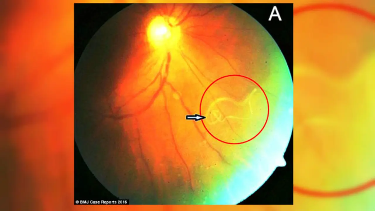 Mengerikan, Cacing Menembus Kornea dan Hidup di Bola Mata - Global ...