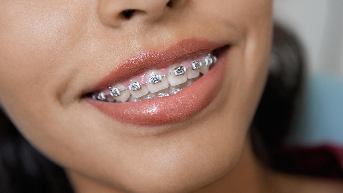 Ragu Pakai Behel Gigi? Coba Cek Manfaatnya - Fashion & Beauty Liputan6.com