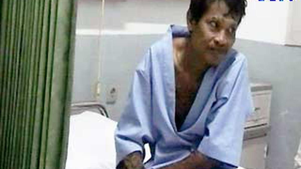 Kutil Kembali Tumbuh, "Manusia Akar" Dioperasi Lagi - News Liputan6.com