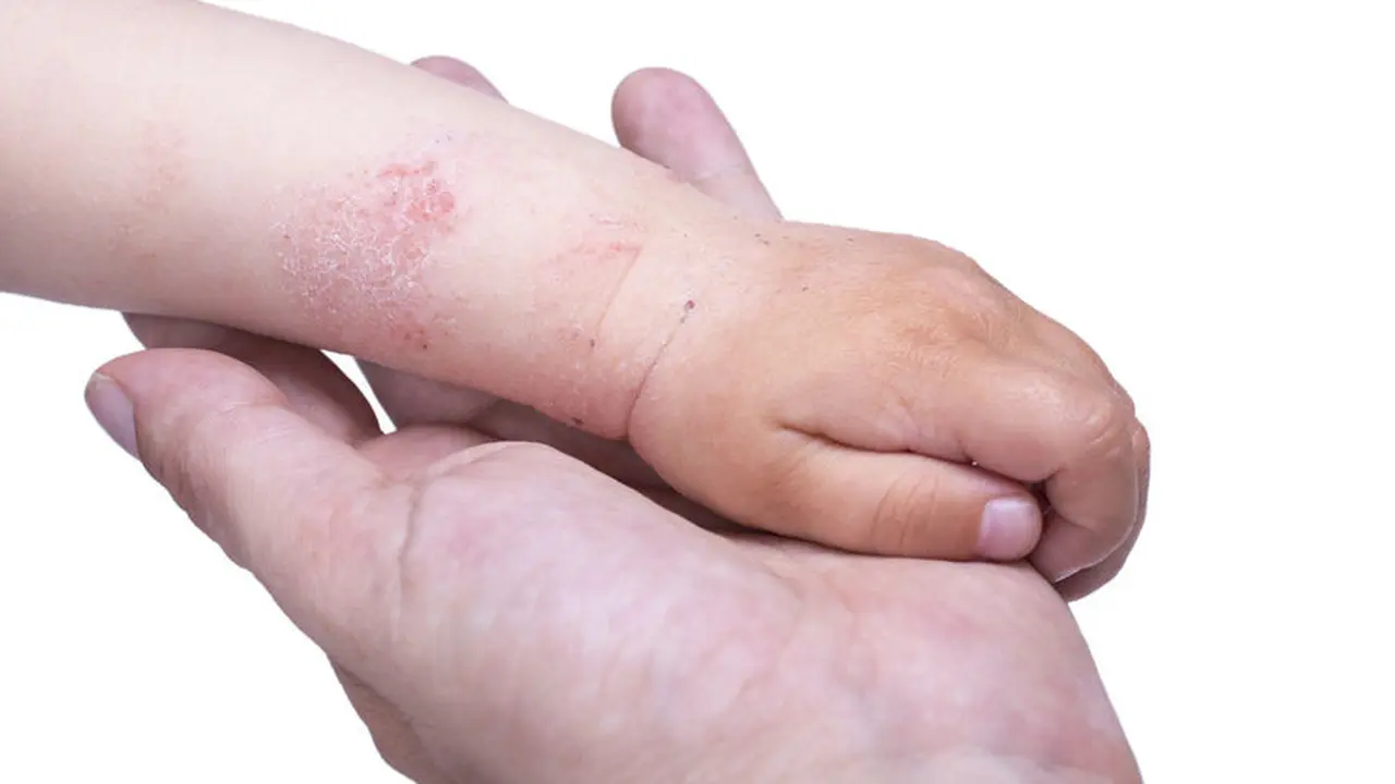 5 Gejala Dermatitis Atopik Pada Bayi, Jangan Dianggap Sepele - Hot ...