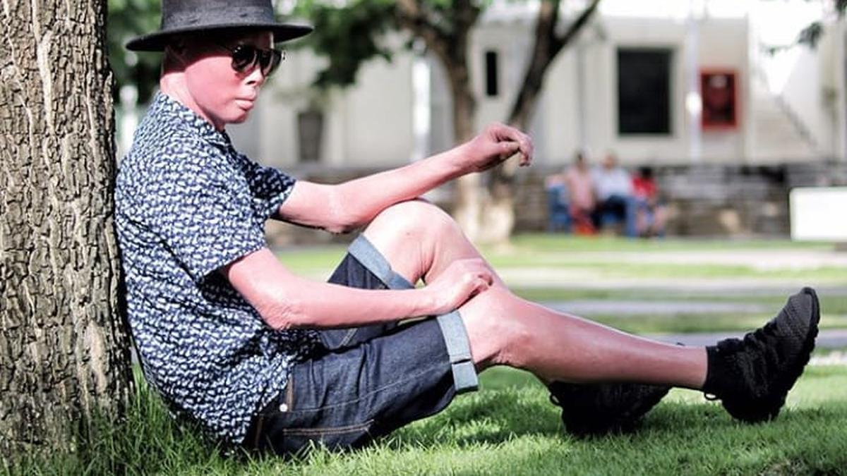 Berbagi Edukasi Ichthyosis via Tik Tok, Koko Merah Curi Perhatian ...