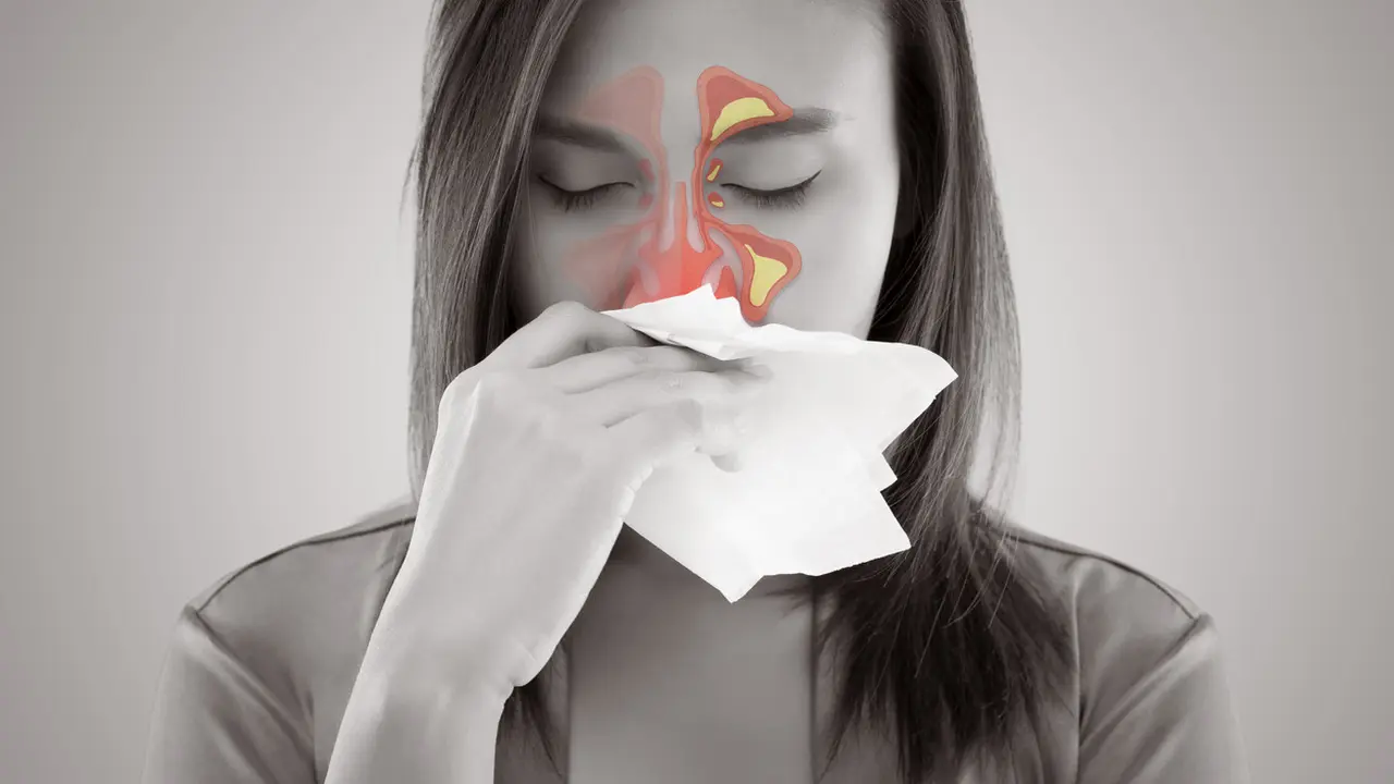 Apa Itu Sinusitis? Kenali Gejala, Penyebab, dan Cara Mengatasinya - Hot ...