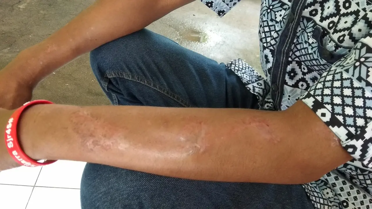 Ciri Ciri Penyakit Kusta: Deteksi Dini dan Penanganan yang Tepat