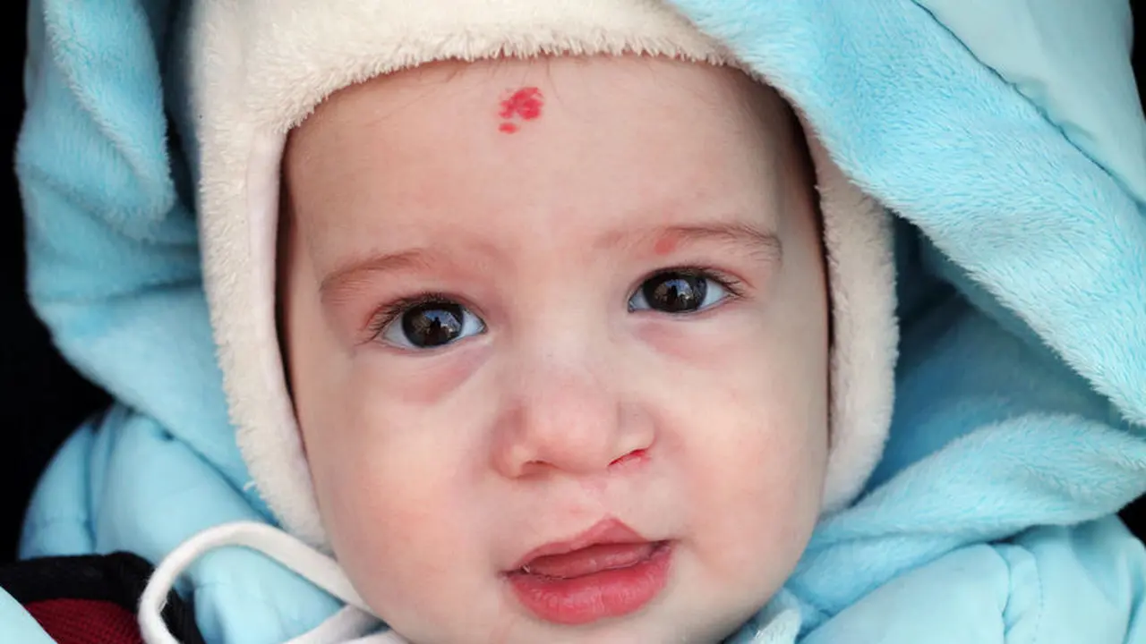 7 Penyebab Bibir Sumbing Pada Bayi, Ketahui Cara Mencegahnya - Hot Liputan6.com