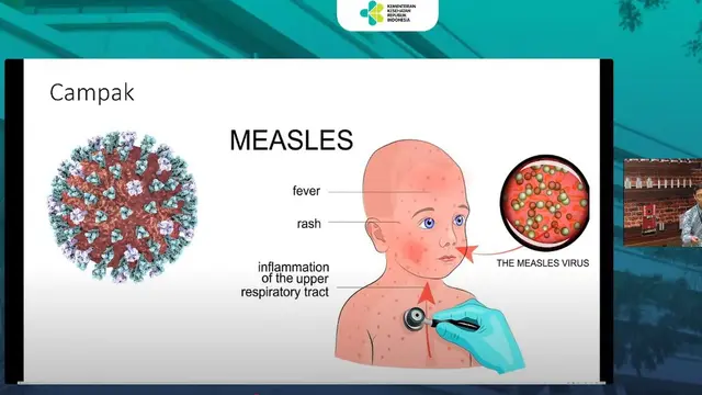 Wabah Campak di Sumenep, Mengenal Virus Penyebabnya yang Sangat Menular ...