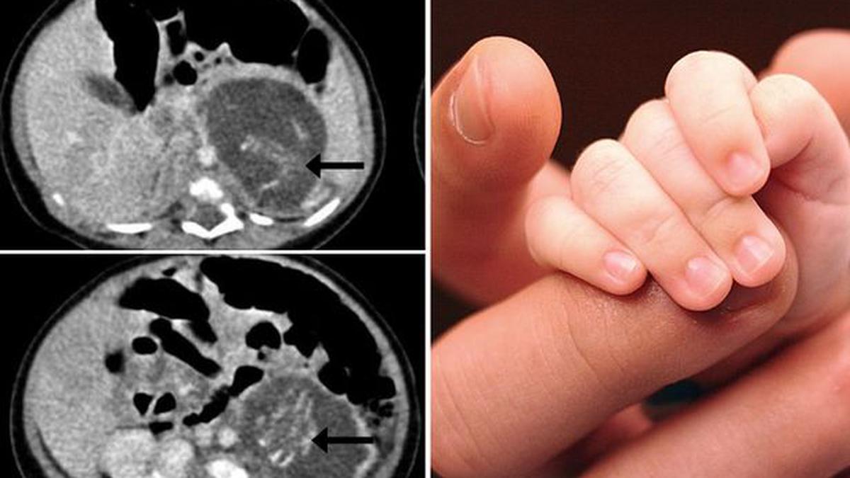 Bayi Baru Lahir `Hamil` Janin Kembar - Health Liputan6.com