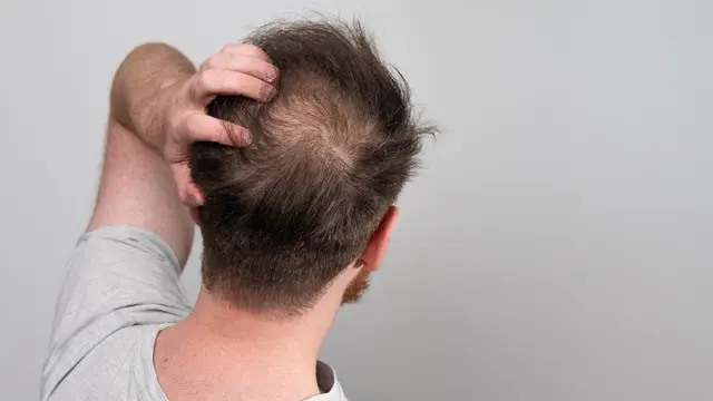 10 Penyebab Rambut Rontok pada Pria yang Berujung Kebotakan, Temukan ...