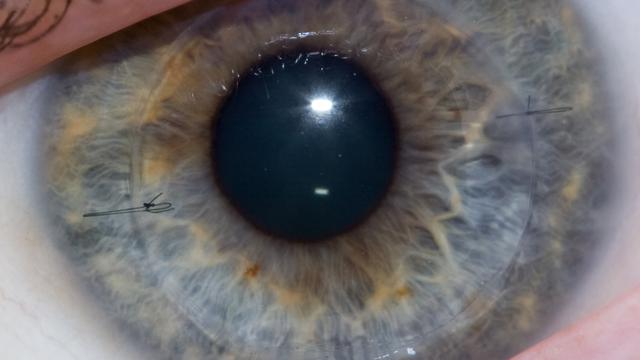 Langkah Awal Atasi Abrasi Kornea Mata - Health Liputan6.com