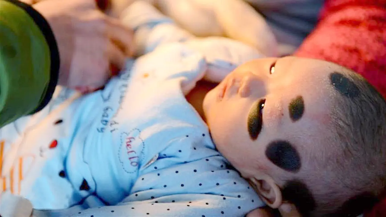 Kulit Tubuh Bayi Ini Berbintik-bintik Hitam Seperti Dalmatian - Health ...