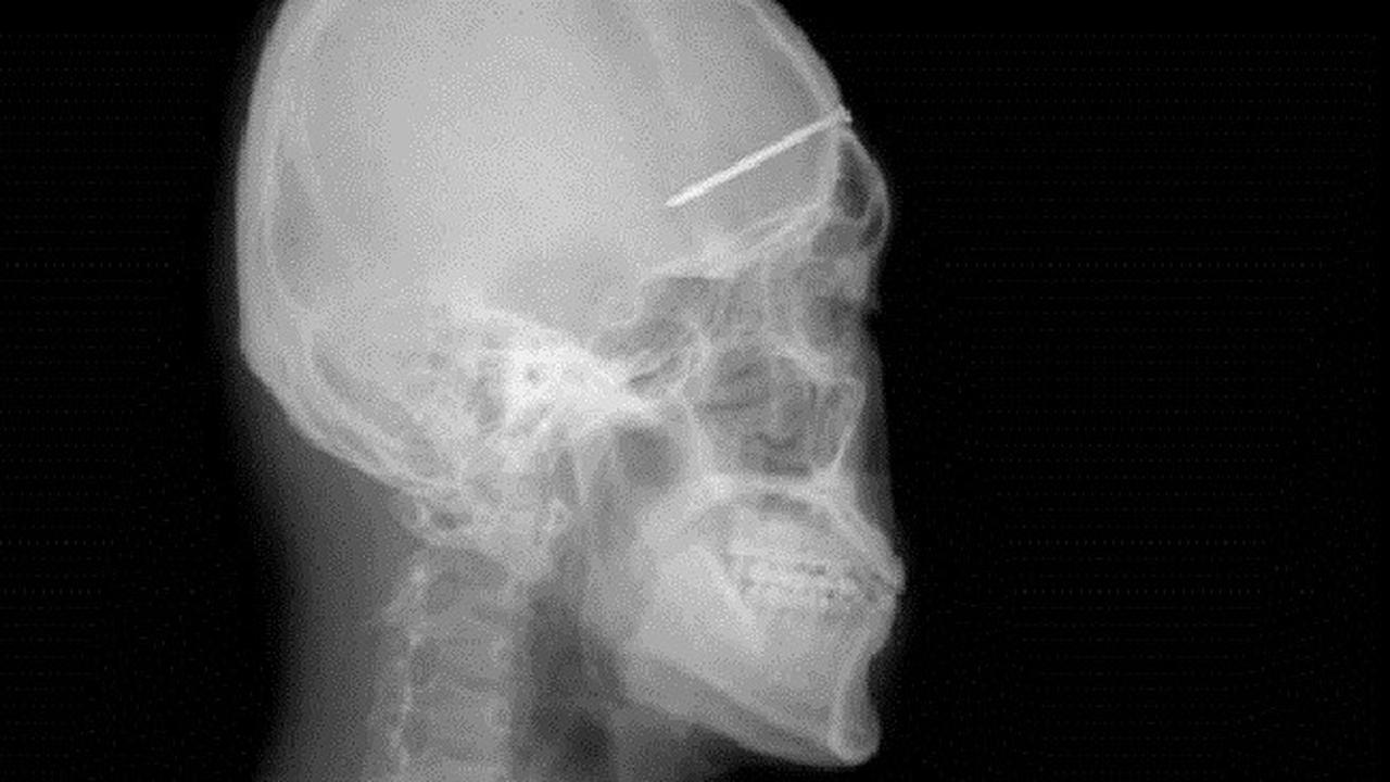 Rontgen Adalah Proses Diagnosis dengan Radiasi Sinar-X, Simak Prosedur ...