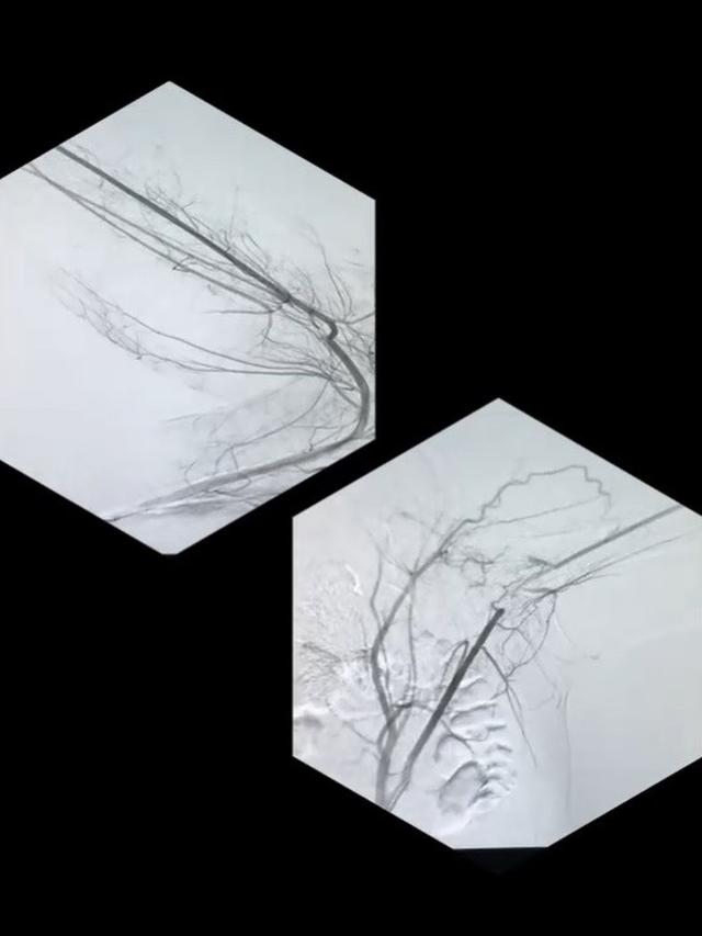 Varises dan Diabetes Bisa Bikin Luka Kaki, Ketahui Penyebab dan ...