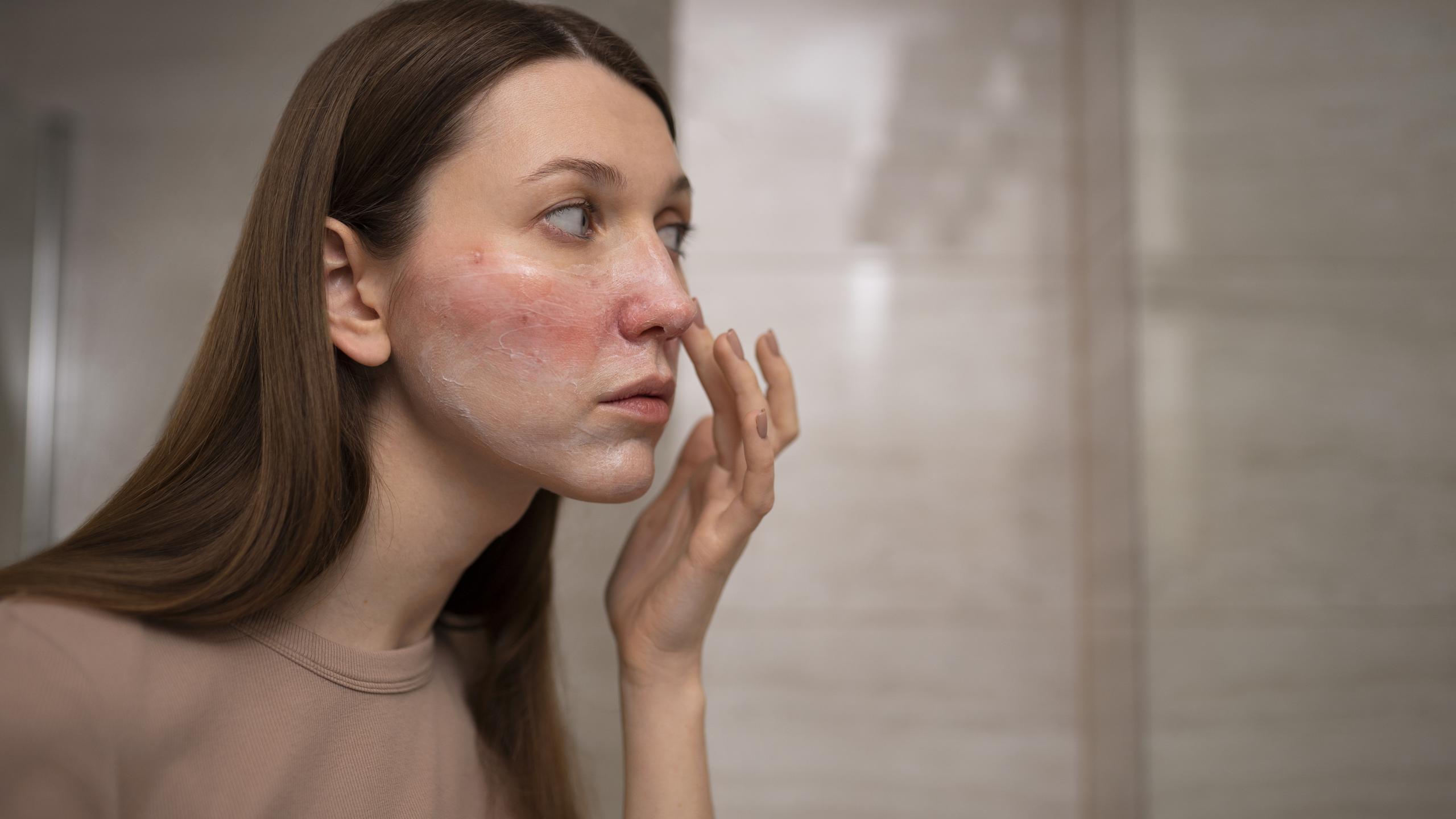 Rosacea Bikin Wajah Merah dalam Jangka Panjang, Kenali Gejala hingga ...