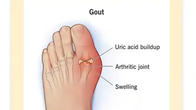 Gejala Khas Asam Urat Tinggi, Kerap Muncul di Kaki dan Tangan - Health ...
