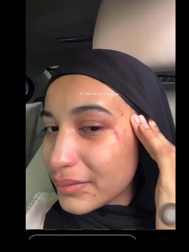 Cut Intan Nabila Perlihatkan Wajah Lebam dan Luka, Tulis Keterangan ...