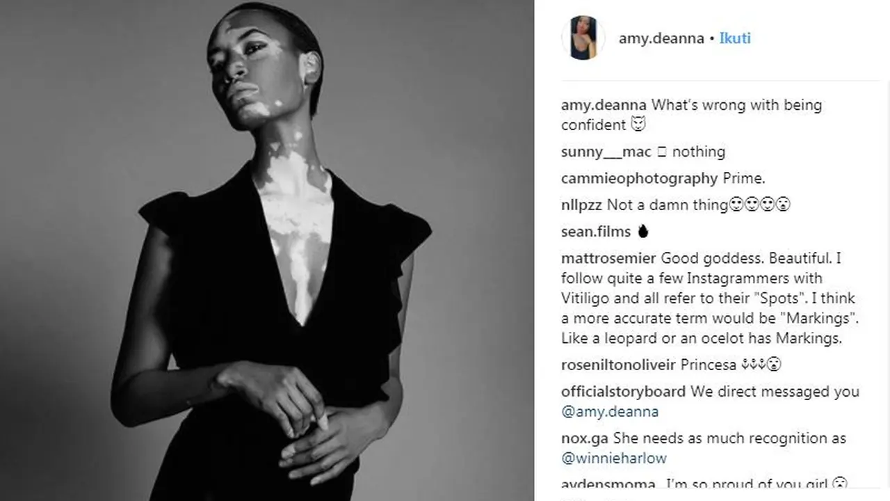 Amy Deanna, Model Penderita Vitiligo Pertama yang Mendunia - Fashion ...