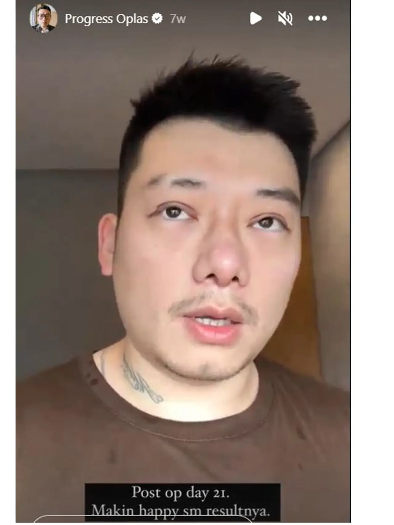 7 Potret Chef William Gozali Jalani Operasi Plastik, Perubahannya Bikin Pangling - Hot Liputan6.com