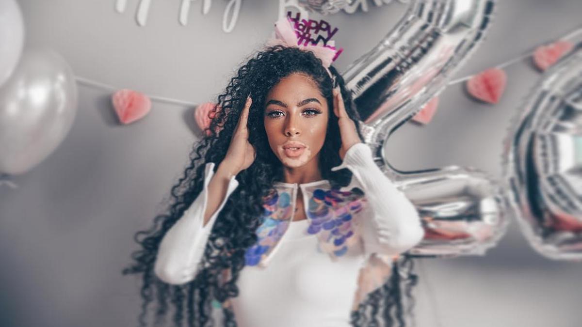 Shahad Salman, Model Pengidap Vitiligo yang Jadi Cover Vogue Arab ...