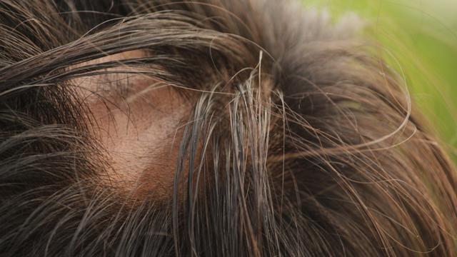 Cara Mengatasi Rambut Rontok, Ketahui Gejala, Penyebab, dan ...