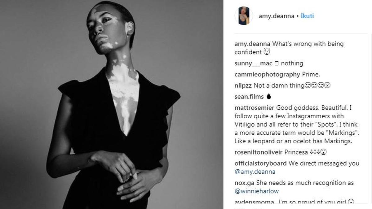 Amy Deanna, Model Penderita Vitiligo Pertama yang Mendunia