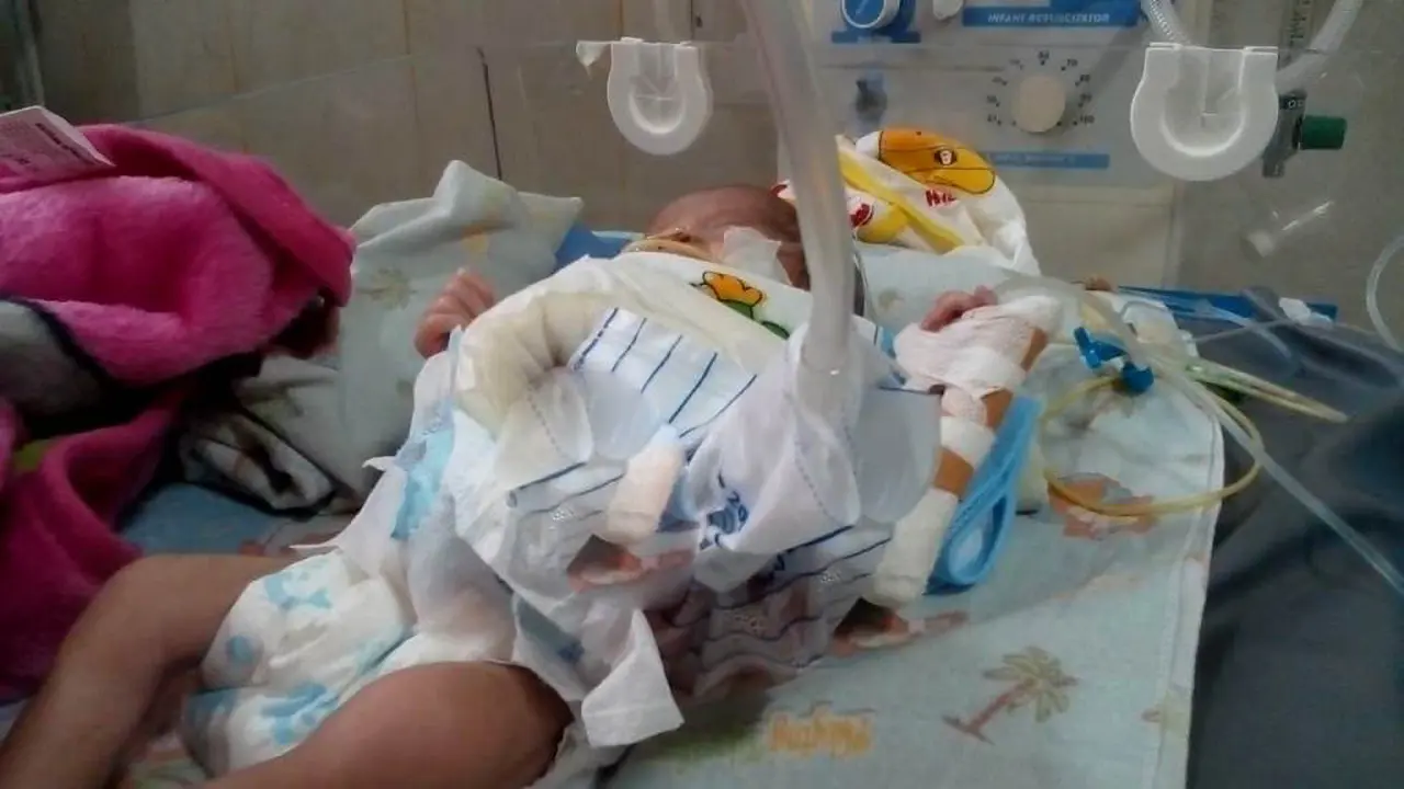 Doa dan Perjuangan untuk Arumi, Bayi dengan Kelainan Dinding Perut ...