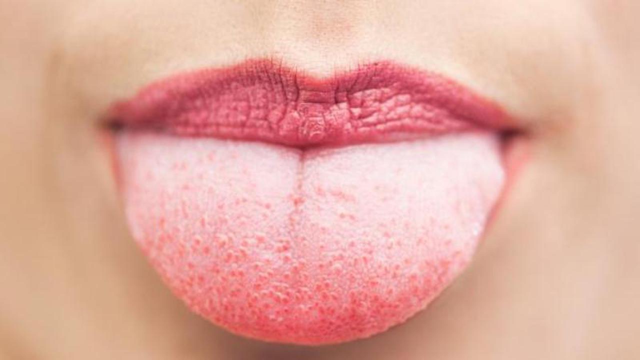 Lidah Putih Tanda Apa? Kenali Arti Warna, Penyebab dan Cara Mengatasinya