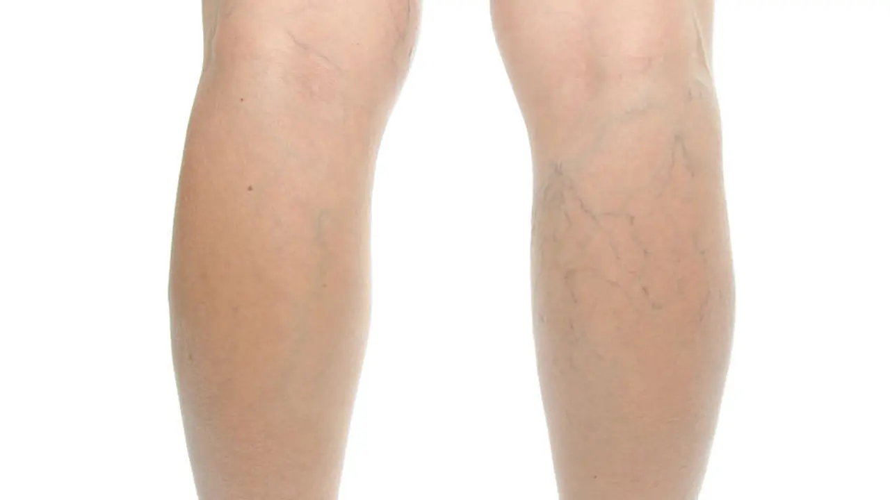 Awas, Varises Timbulkan Serangan Jantung - Health Liputan6.com