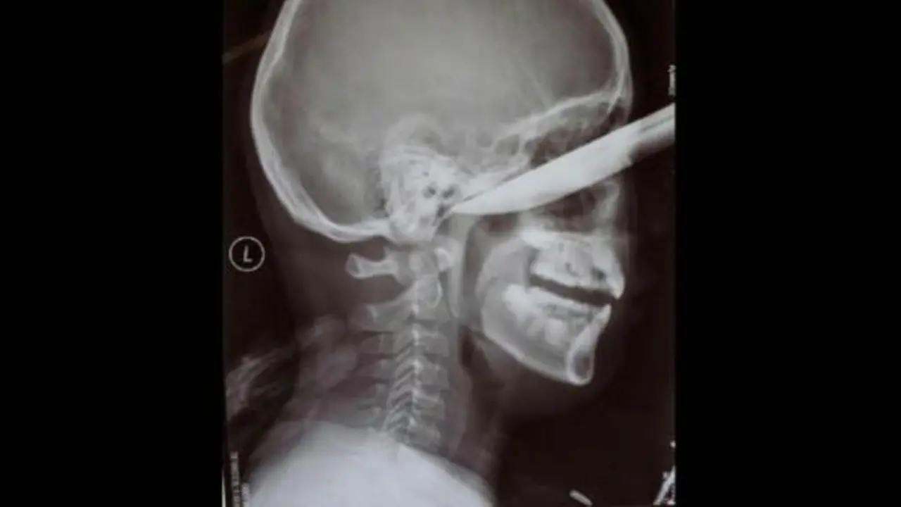 4 Foto Rontgen Ini Bikin Ngilu, Ada yang Tertancap di Kepala - Citizen6 ...