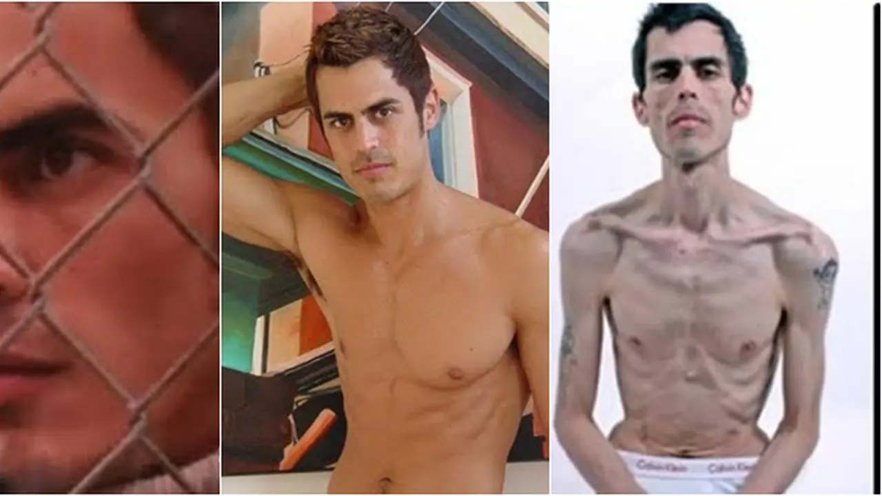 Ngeri, Ini 7 Penampakan Anoreksia Paling Tragis di Dunia - Lifestyle ...