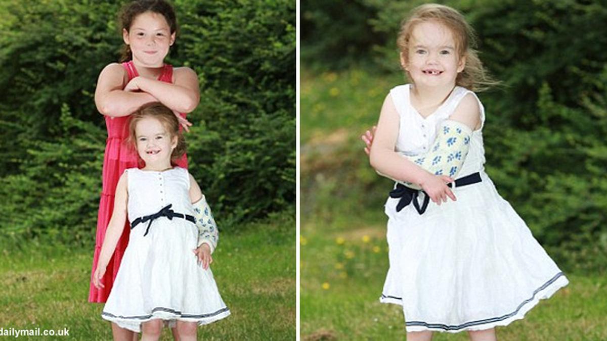 Derita `Dwarfisme`, Gadis Ini Tak Tumbuh Lagi dan Jadi Kerdil