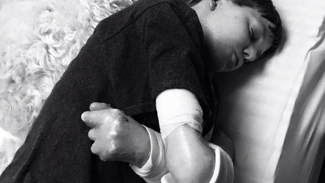 Kisah John Hudson Berjuang Melawan Penyakit Kulit Langka