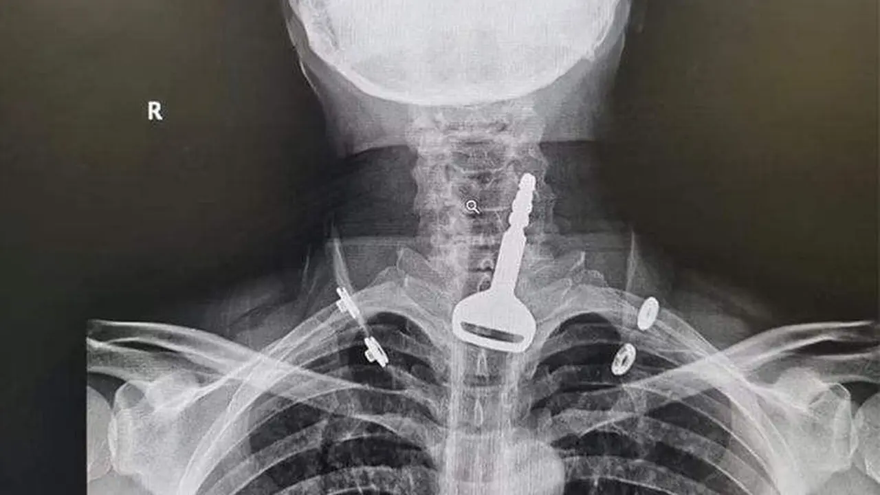 Rontgen Adalah Proses Diagnosis dengan Radiasi Sinar-X, Simak Prosedur ...