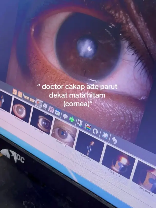 Sering Kucek Mata, Pemuda 21 Tahun Berakhir Harus Transplantasi Kornea ...