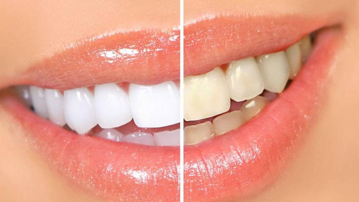 Tips Memutihkan Gigi: Panduan Lengkap untuk Senyum Cemerlang - Feeds ...