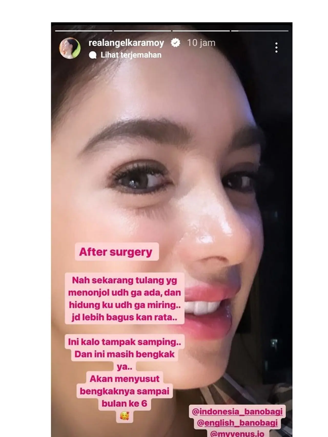 8 Potret Angel Karamoy Sebelum vs Setelah Operasi Plastik, Hasilnya ...