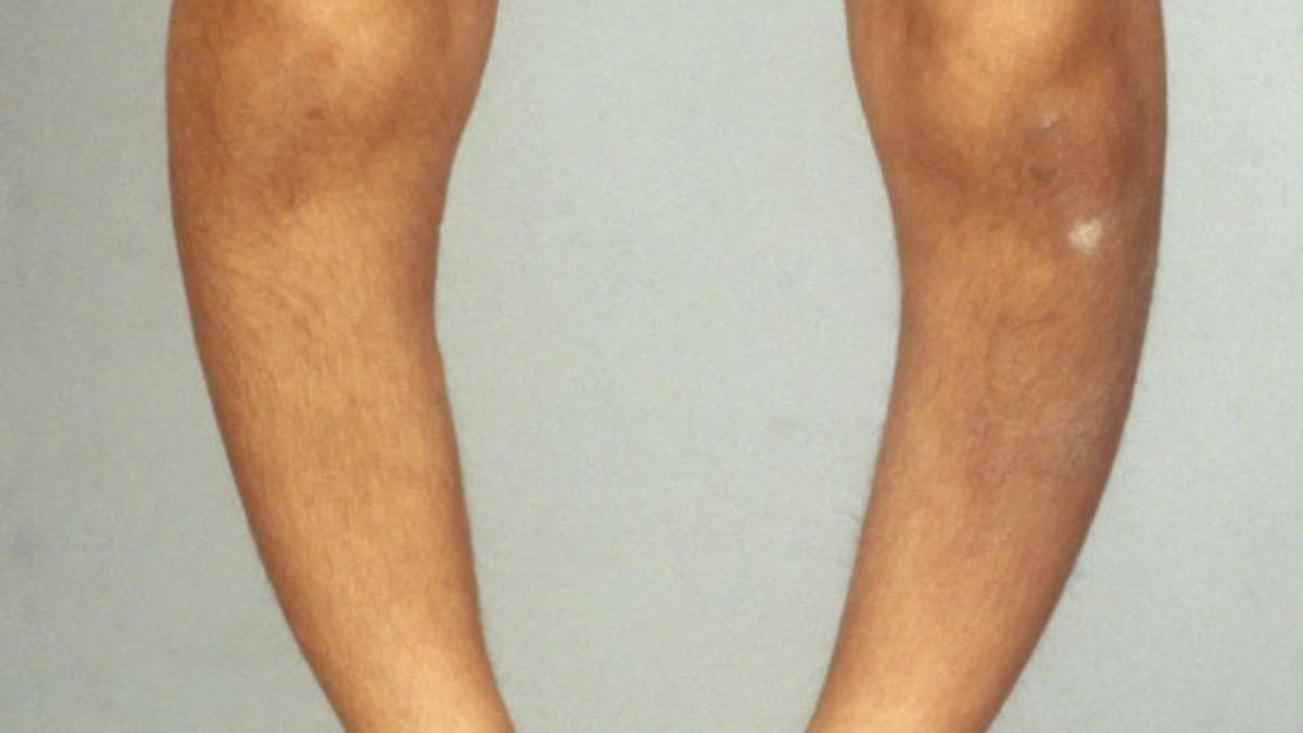 Penyebab Penyakit Rakitis, Kenali juga Gejala dan Cara Pengobatannya