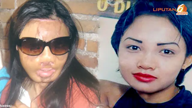 Lisa Face Off Operasi Permak Wajah di 3 Titik - Health Liputan6.com