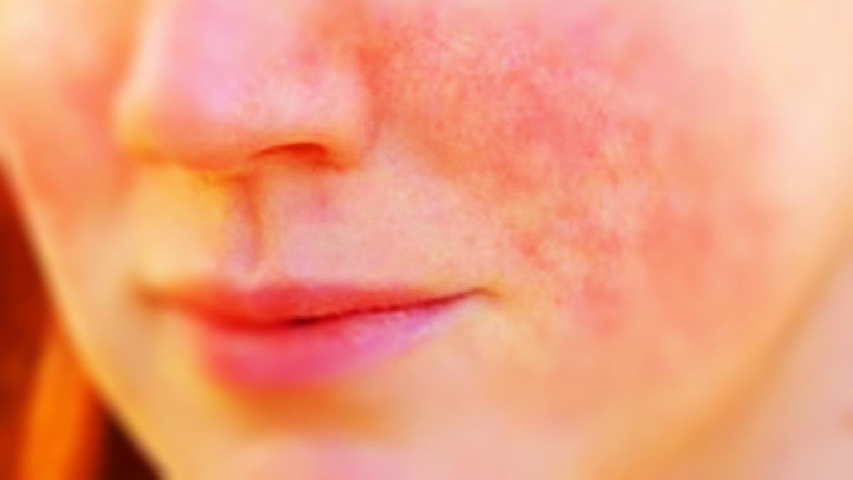 Penyebab Lupus, Gejala, Jenis, dan Pengobatannya yang Perlu Diketahui ...