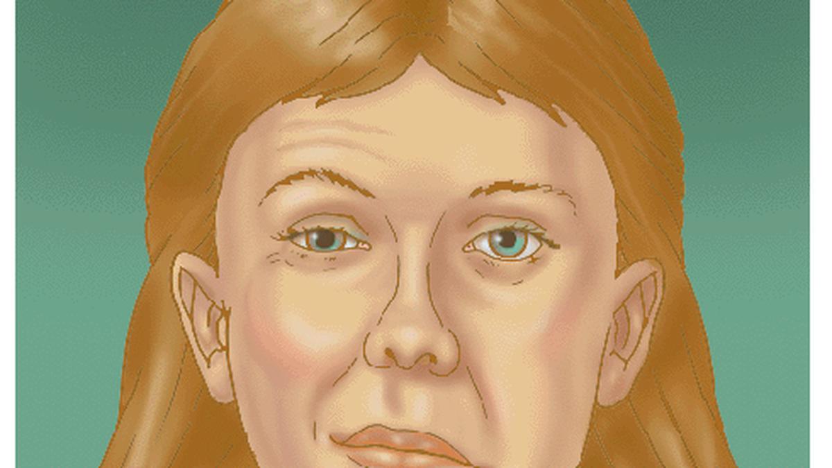 Bell's Palsy, Saat Sebagian Wajah Perot