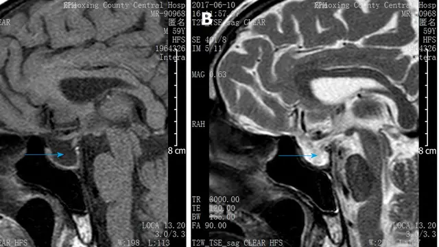 Apa Itu Empty Sella Syndrome? Berikut Penyebab dan Gejalanya - Regional ...