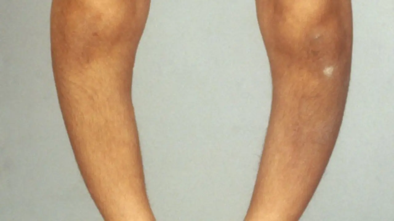 Penyebab Penyakit Rakitis, Kenali juga Gejala dan Cara Pengobatannya ...