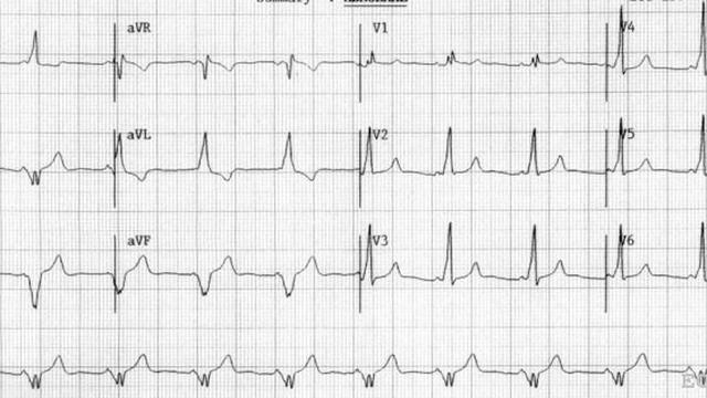 9 Cara Membaca EKG untuk Pemeriksaan Jantung, Pahami Tahapannya - Hot ...