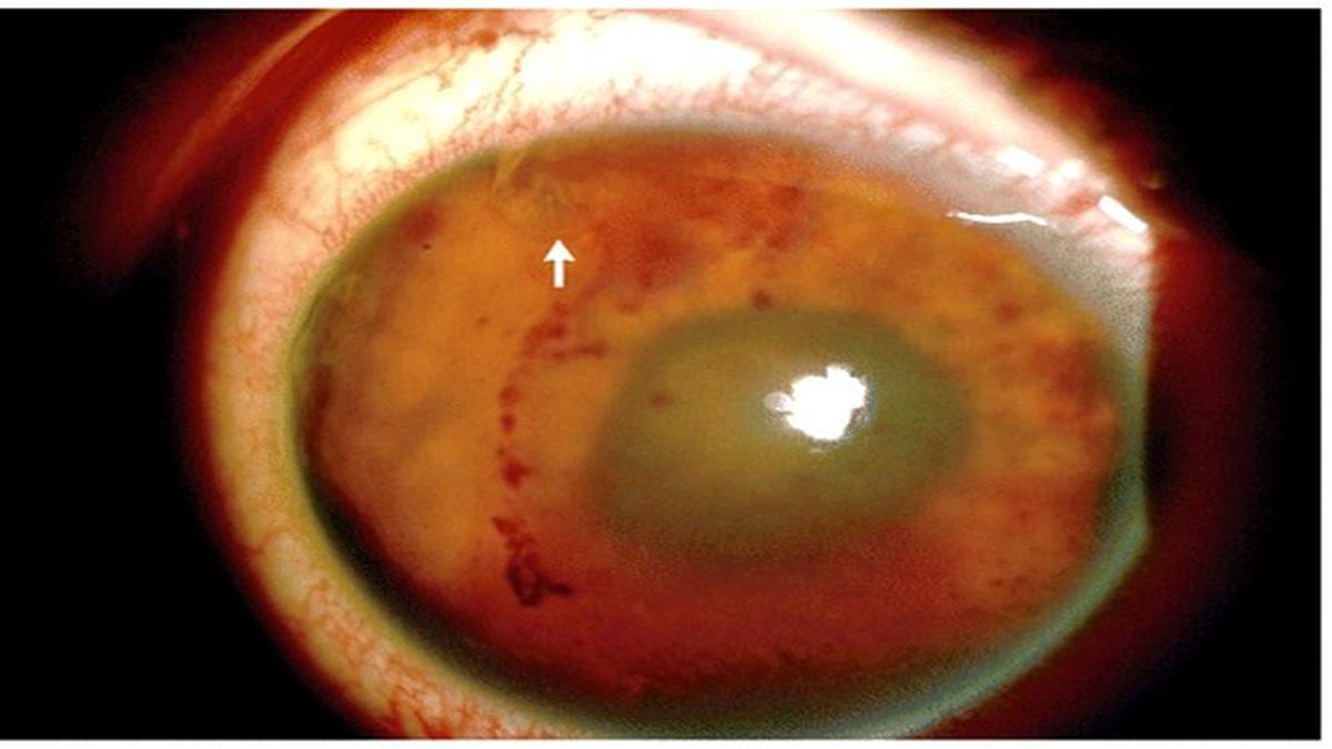 Remaja Kehilangan Penglihatan Akibat Cacing Parasit di Mata - Health ...