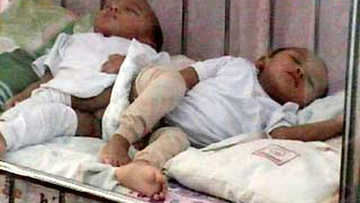 Kembar Siam Dempet Pinggul Segera Dioperasi - News Liputan6.com