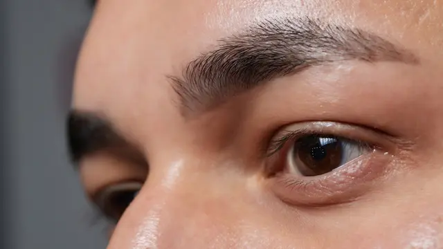 Jerawat di Alis Pria, Ketahui Penyebab dan Cara Mengatasinya - Health ...