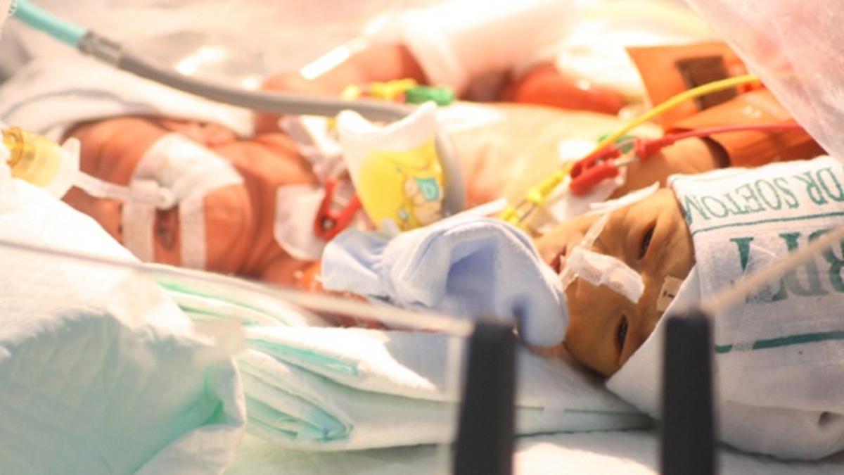 Ivone, Bayi Kembar Dempet Perut, Dimakamkan Hari Ini - Regional ...