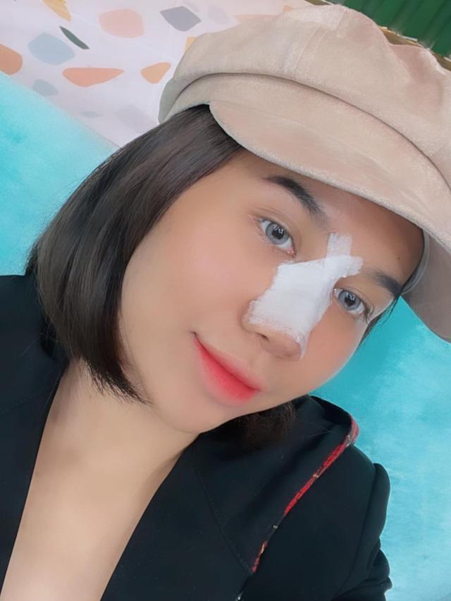 8 Potret Perubahan Wajah Mayang Usai Operasi Hidung, Sudah Lepas Perban