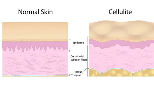 Kulit Selulit Hukuman Seumur Hidup - Health Liputan6.com