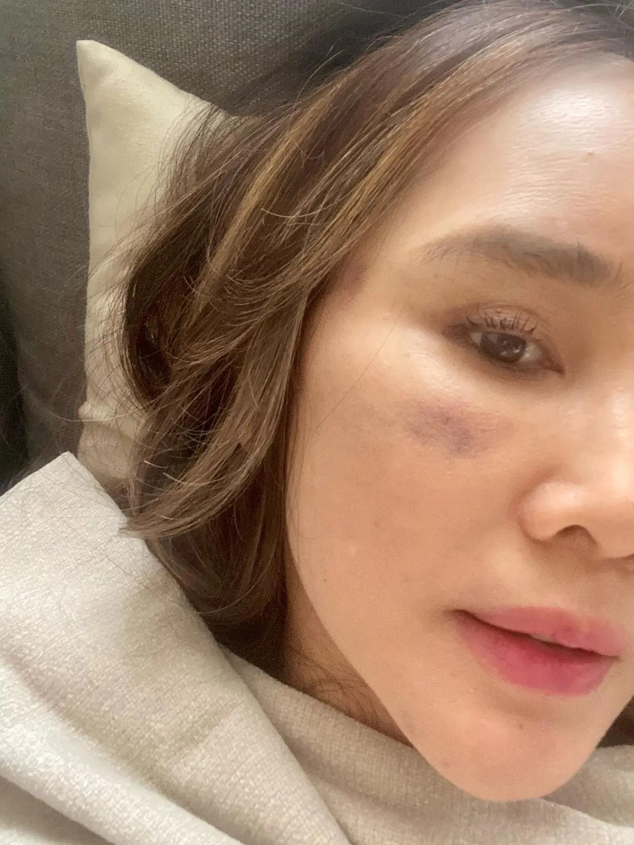 10 Potret Jeremy dan Ina Thomas Jalani Operasi Plastik di Korea, Jadi ...